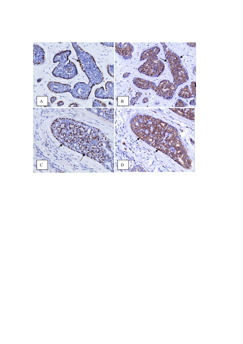 Increased numbers of P63-positive/CD117-positive cells in advanced ...
