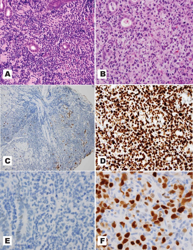 Gastrointestinal lymphomas in a North American population ...