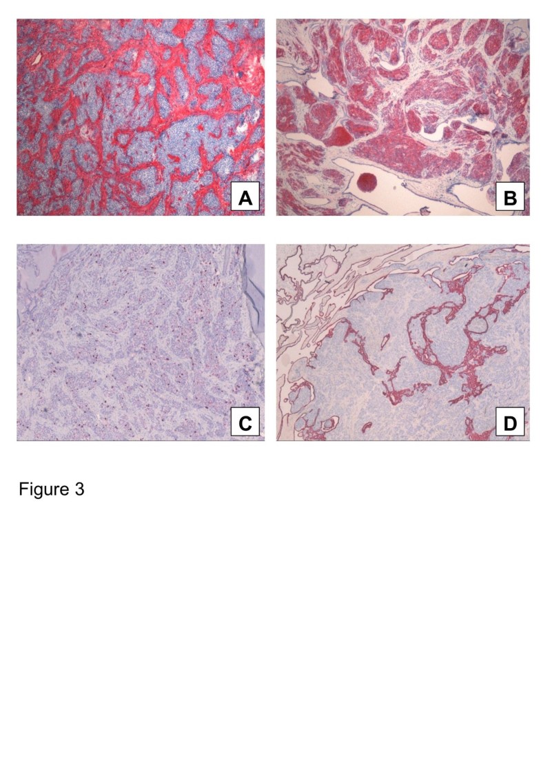 Sertoliform Cystadenoma A Rare Benign Tumour Of The Rete Testis