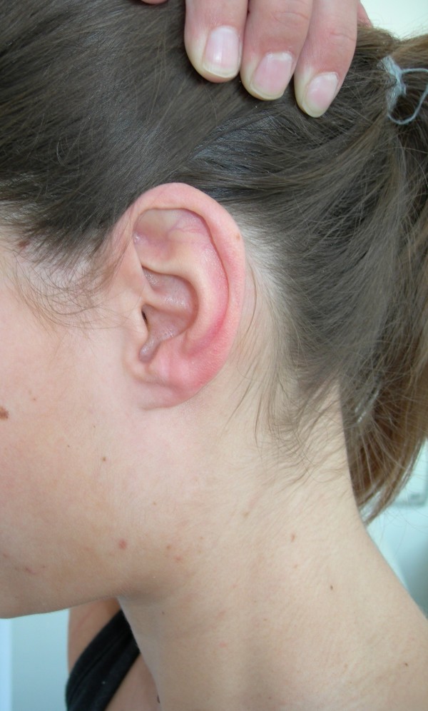 Combination of surgical excision and custom designed silicon pressure ...