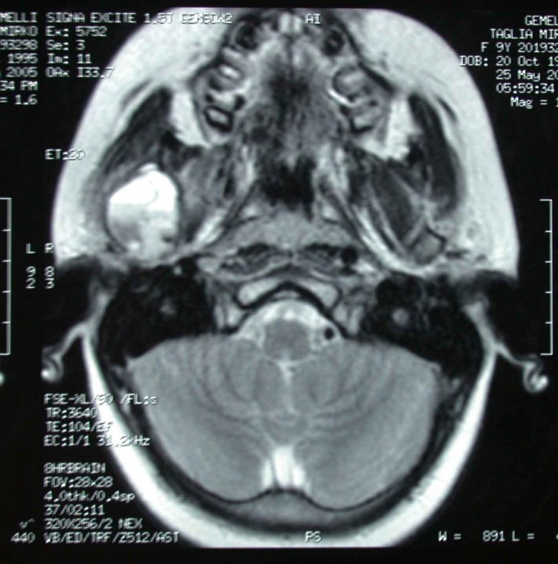 Aneurysmal Bone Cyst located in the Mandibular Condyle | Head & Face ...