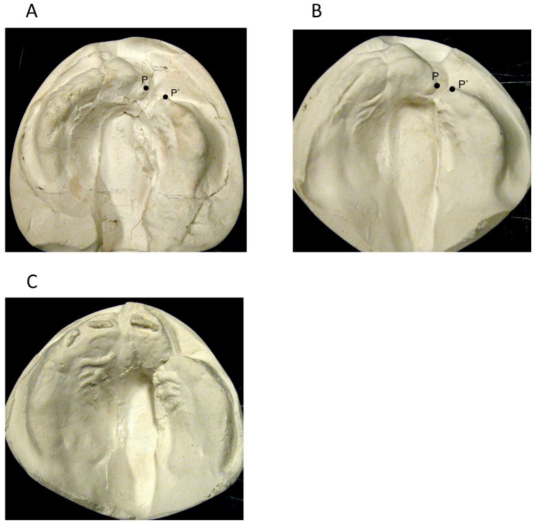 Influence of lip closure on alveolar cleft width in patients with cleft ...