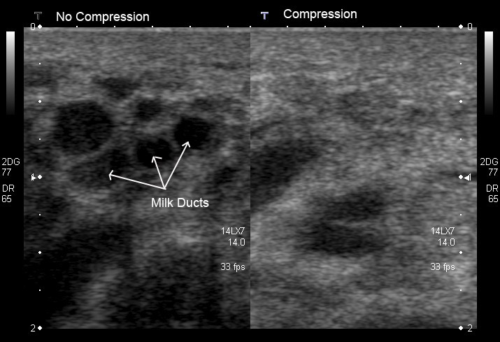 Ultrasound imaging of the lactating breast: methodology and application ...