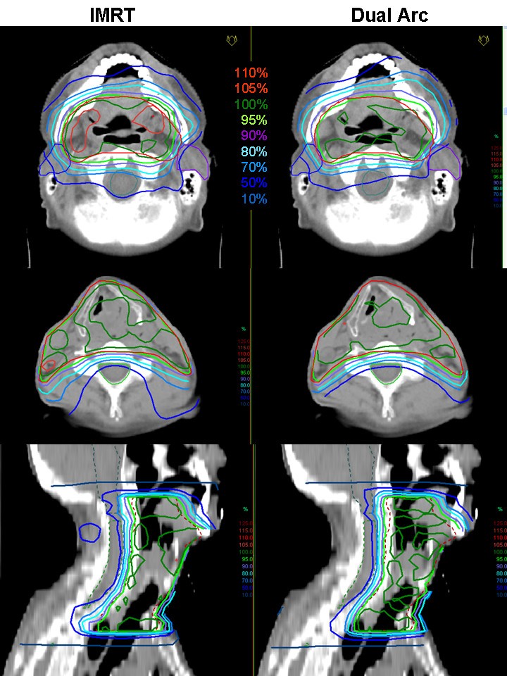 Application of volumetric modulated arc therapy (VMAT) in a dual-vendor ...