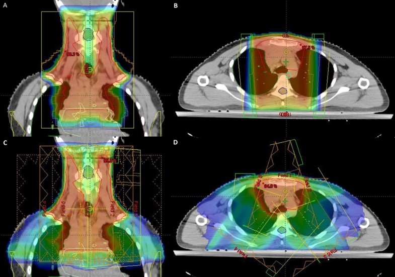 Intensity modulated radiotherapy in early stage Hodgkin lymphoma ...