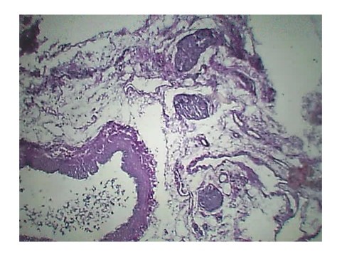 Exsanguinating upper GI bleeds due to Unusual Arteriovenous ...