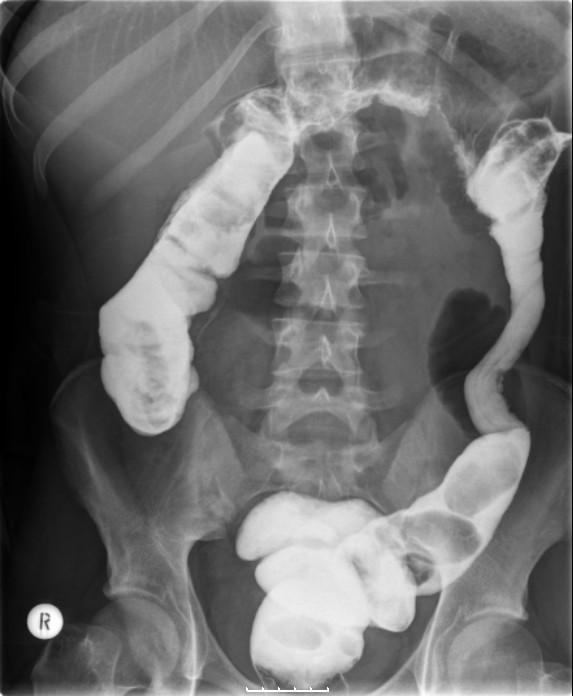 Transverse colon volvulus in a 15 year old boy and the review of the ...