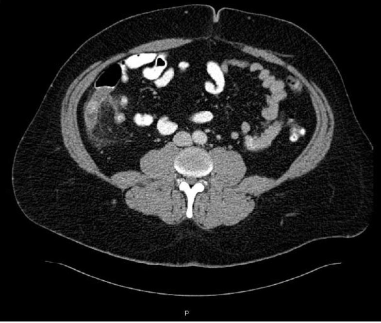 Non-trocar related major retroperitoneal bleeding during laparoscopic ...