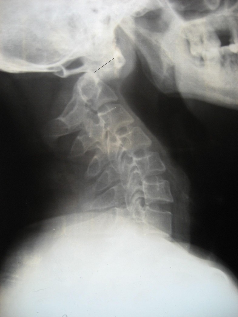 Transarticular screw fixation for atlantoaxial instability - modified ...