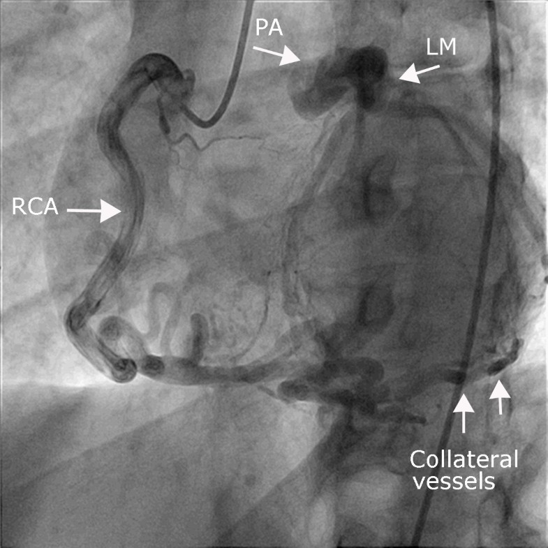 Anomalous origin of the left coronary artery from the pulmonary artery ...