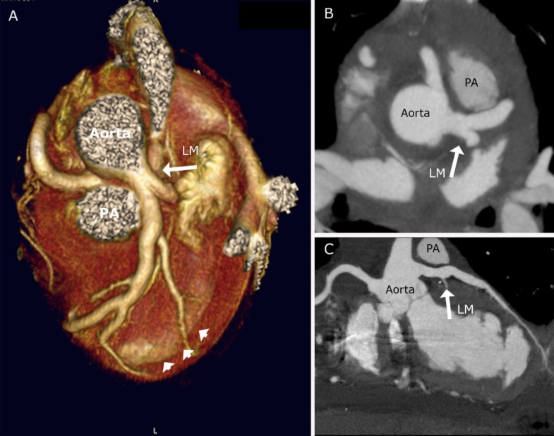 Anomalous origin of the left coronary artery from the pulmonary artery ...