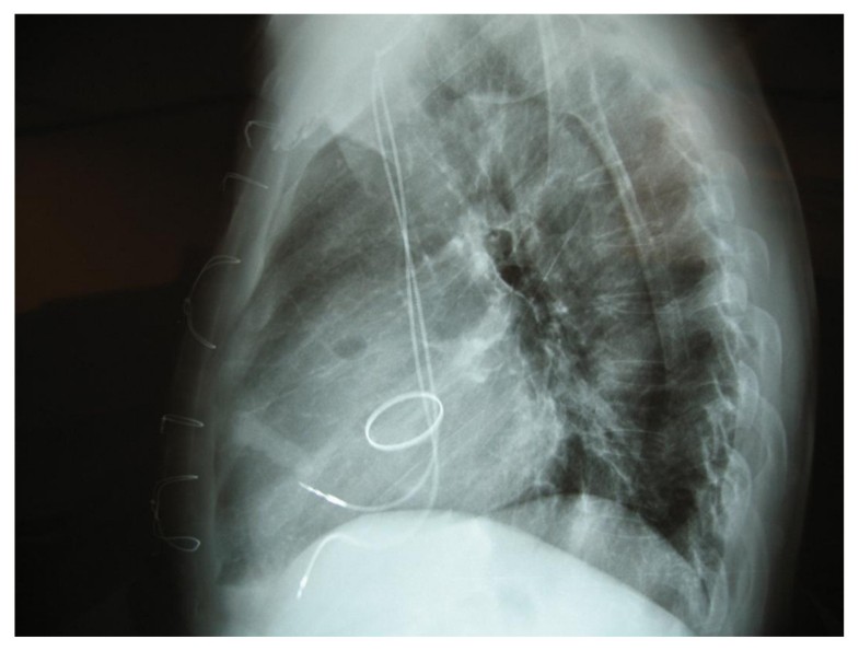 Bentall procedure 39 years after implantation of a Starr-Edwards Aortic ...