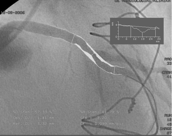 Various clinical scenarios leading to development of the string sign of ...