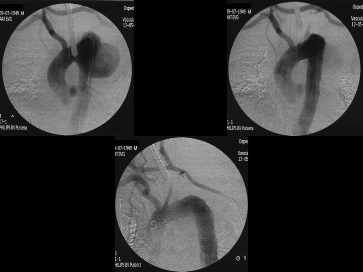 Ruptured hemiarch and descending thoracic aorta aneurysm: hybrid ...