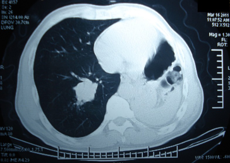 Right lower lobectomy eight years after left pneumonectomy for a second ...