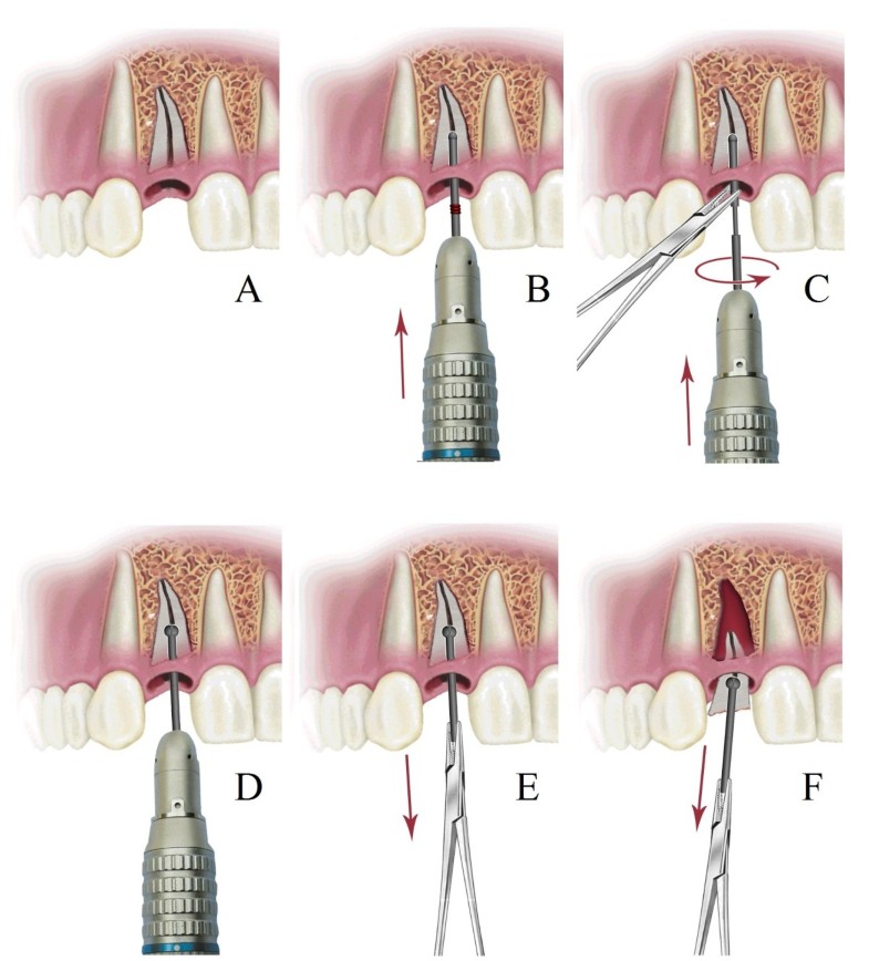 Expandable Micro-motor Bur, design of a new device for least invasive ...