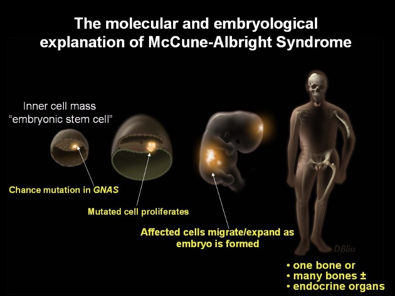 McCune-Albright syndrome | Orphanet Journal of Rare Diseases | Full Text