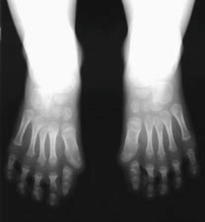 Fibrodysplasia Ossificans Progressiva: Clinical and Genetic Aspects ...