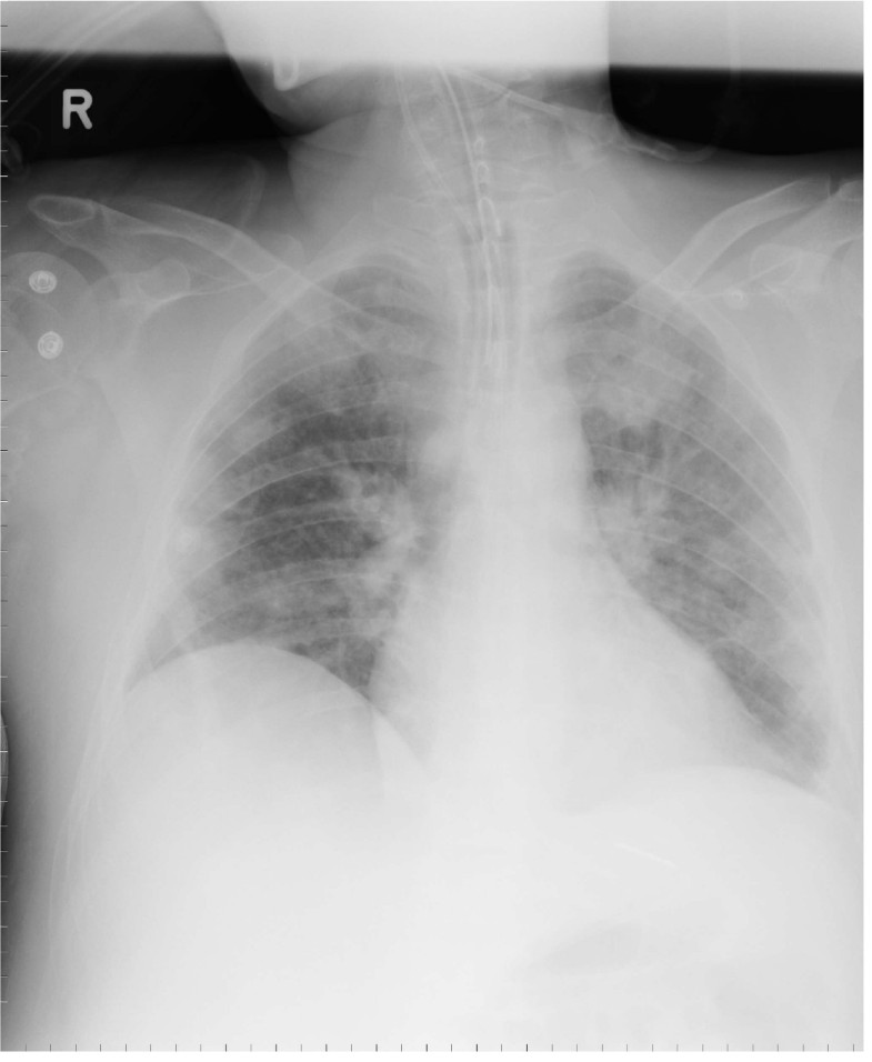 Therapy-refractory Panton Valentine Leukocidin-positive community ...