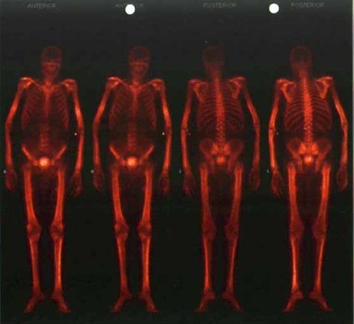 Hypertrophic osteoarthropathy as the cause of a super scan of the bone ...