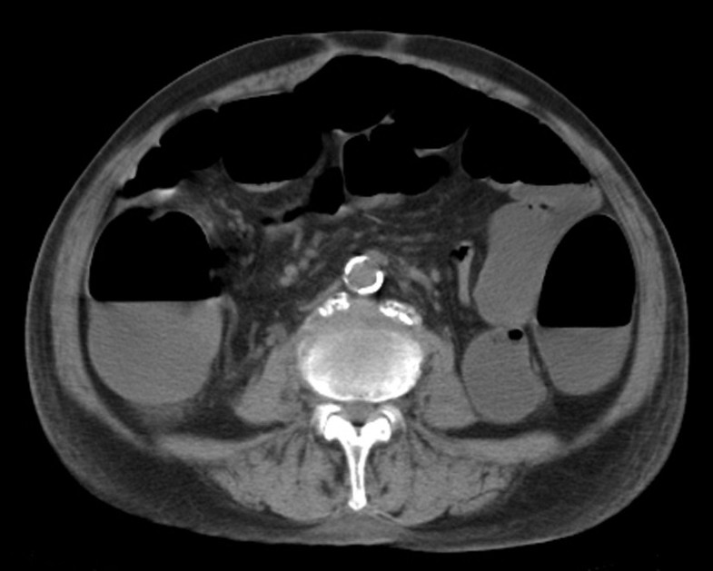 Cytomegalovirus colitis after systemic chemotherapy in a patient with ...