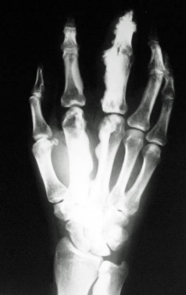 A patient with Melorheostosis manifesting with features similar to ...