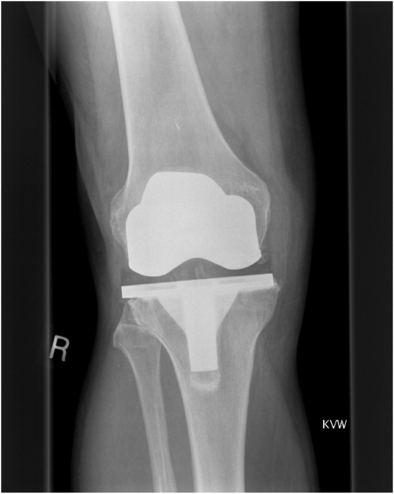 Unique relationship between osteophyte and femoral-tibia component size mismatch in determining ...