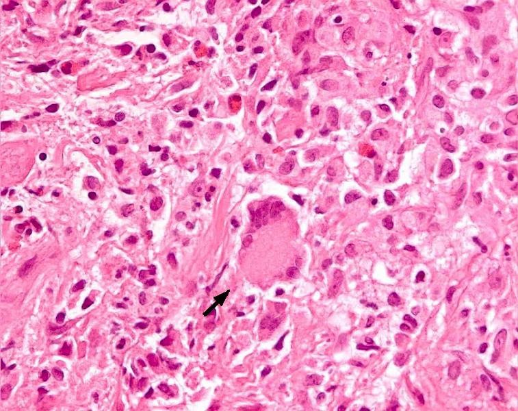 Tuberculosis of the breast with erythema nodosum: a case report ...