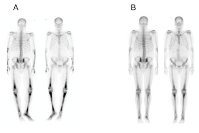 Reversible bone pain and symmetric bone scan uptake in a dialysis ...