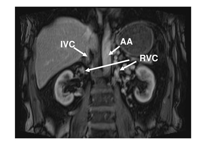 Patent abdominal subcutaneous veins caused by congenital absence of the ...