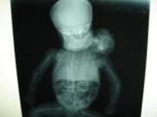 Dicephalus parapagus conjoined twins discordant for anencephaly: a case ...