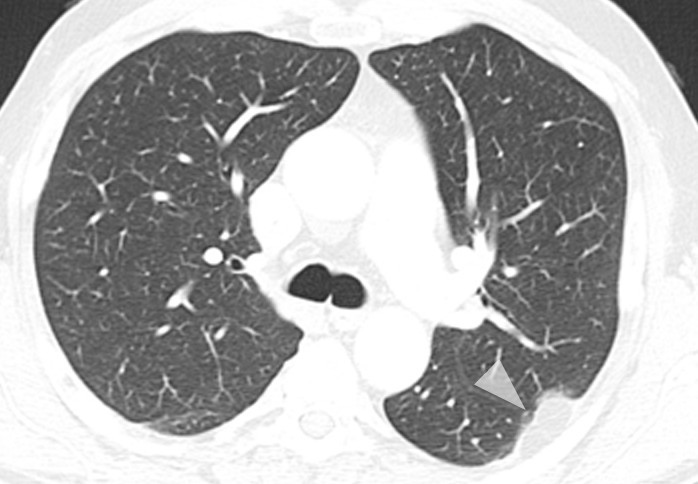 Computed tomography imaging of subpleural lipoma in two men: two case ...