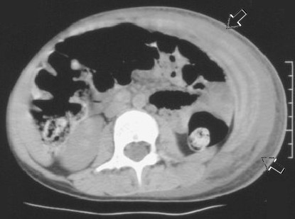 Abdominal wall and labial edema presenting in a girl with Henoch ...