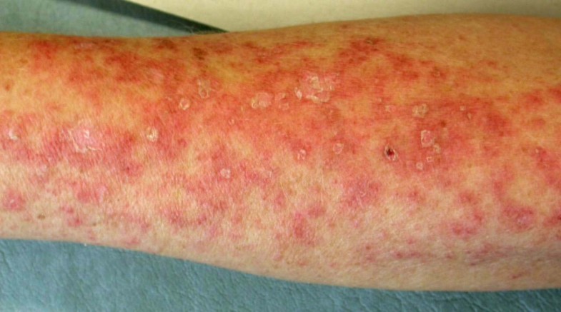 Cutaneous lupus erythematosus after treatment with paclitaxel and ...