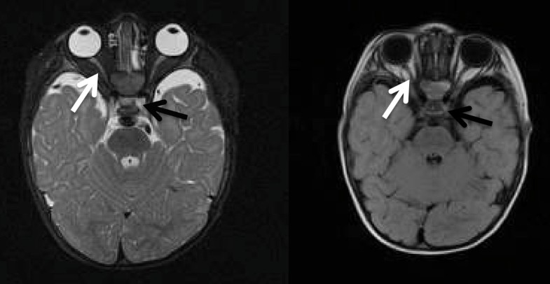 Congenital aplasia of the optic chiasm and esophageal atresia: a case ...