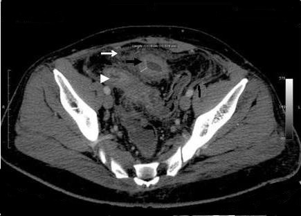 Ileosigmoid fistula and delayed ileal obstruction secondary to blunt ...