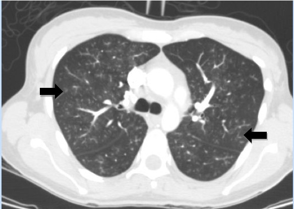 Diffuse bronchiolitis pattern on a computed tomography scan as a ...
