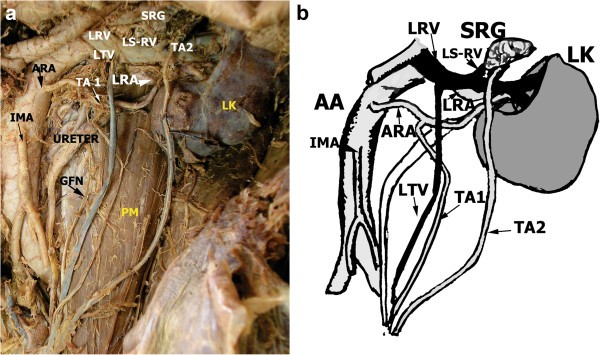 An unusual origin of the double left testicular artery in a male ...