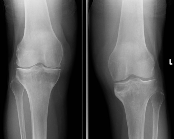 Bilateral atypical insufficiency fractures of the proximal tibia and a ...