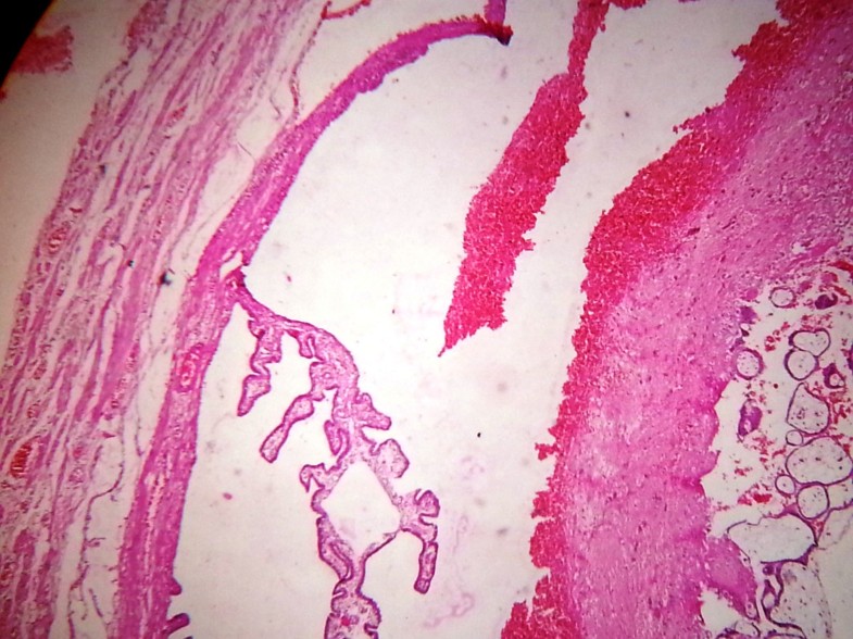 Viable intrauterine pregnancy after spontaneous bilateral tubal ...