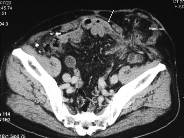 Parastomal hernias successfully repaired using a modified components ...