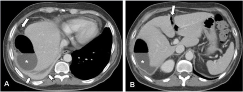 Perforated duodenal ulcer presenting with a subphrenic abscess revealed ...