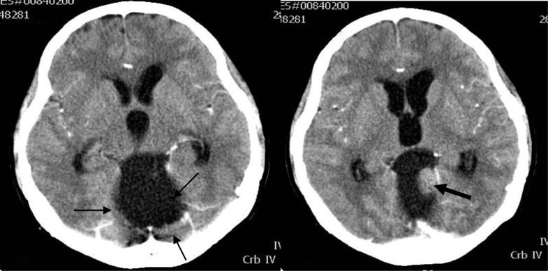 Infratentorial benign cystic meningioma mimicking a hemangioblastoma ...