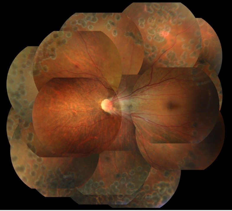 Recurrent vitreous hemorrhage associated with regressed retinopathy of ...