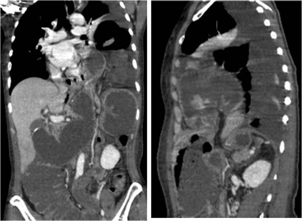 Acute hiatal hernia: a late complication following gastrectomy ...