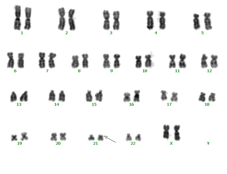 A rare de novo duplication of chromosome 21q22.12 → q22.3 with other ...