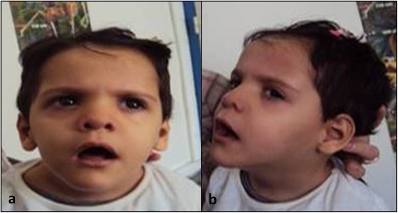 A new case of de novo 19p13.2p13.12 deletion in a girl with overgrowth ...