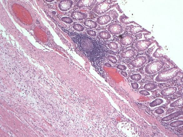 Diverticular disease of the right colon | BMC Research Notes | Full Text