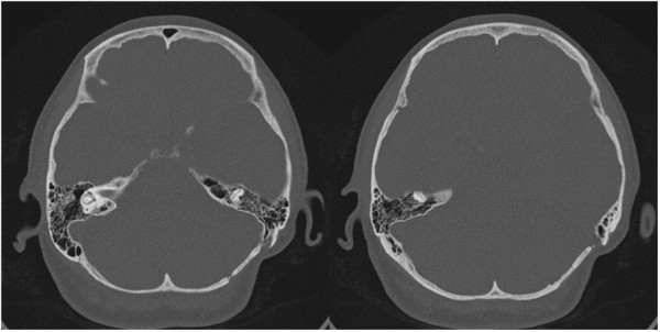 Bone chips, fibrin glue, and osteogeneration following lateral ...