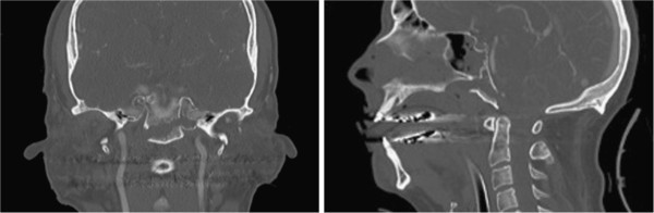 Management of an extended clivus fracture: a case report | BMC Research ...
